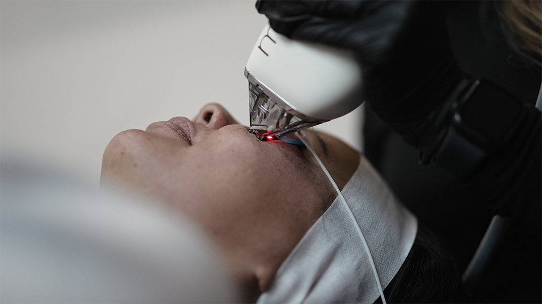 Laser Skin Resurfacing London Ontario | Kontour Medical Aesthetics
