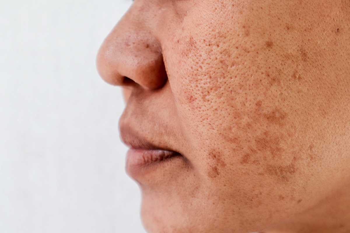 Pigmentation Treatment London Ontario | Kontour Medical Aesthetics